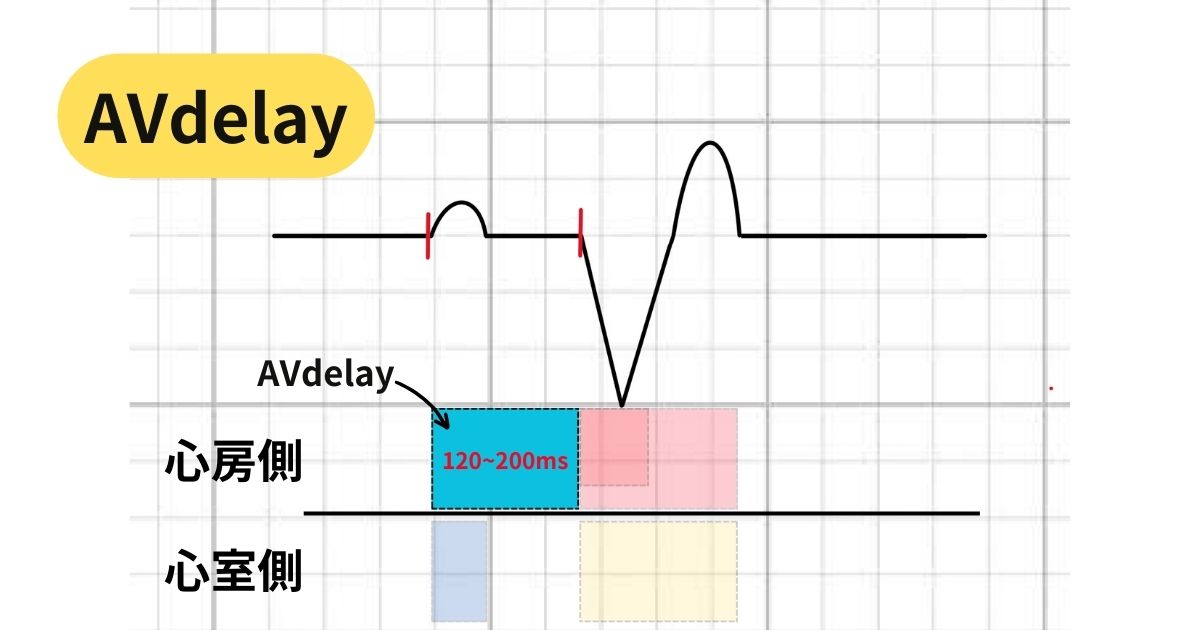 AV delayと不応期 | CEスタディ