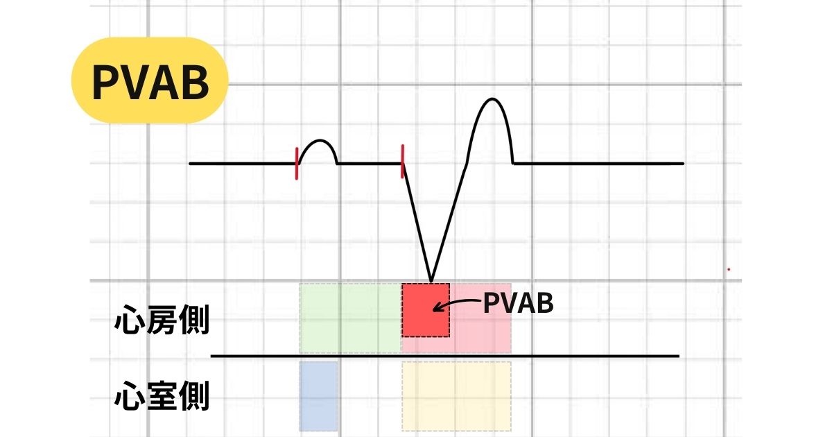 AV delayと不応期 | CEスタディ