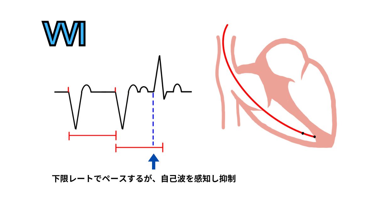 ペーシングモード | CEスタディ