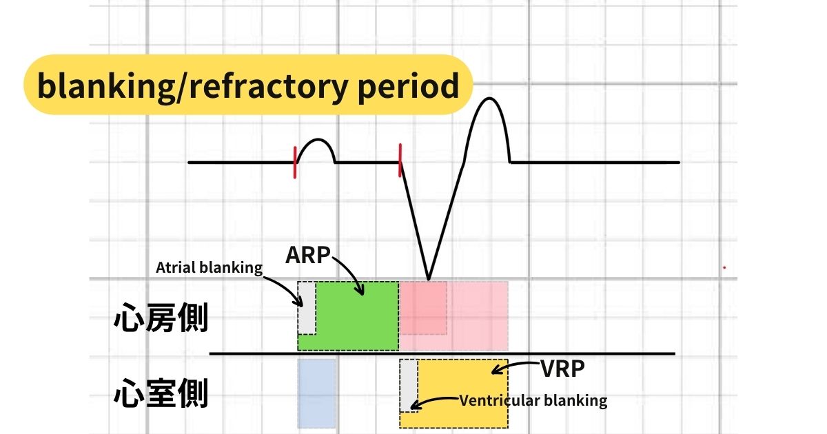 AV delayと不応期 | CEスタディ